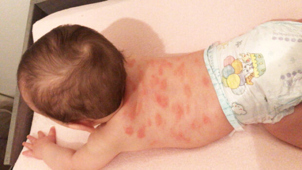 Constitutioneel eczeem bij je baby - hoe ga je hiermee om? | BABYLABEL